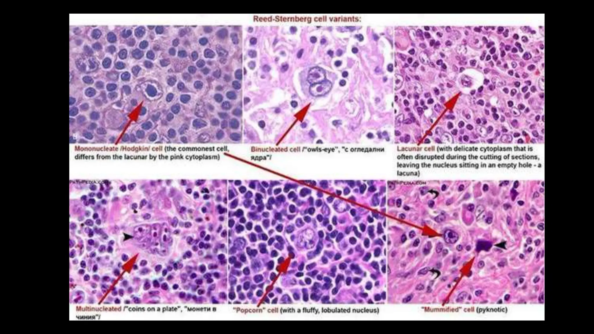 ROUND CELL TUMOR.pptx