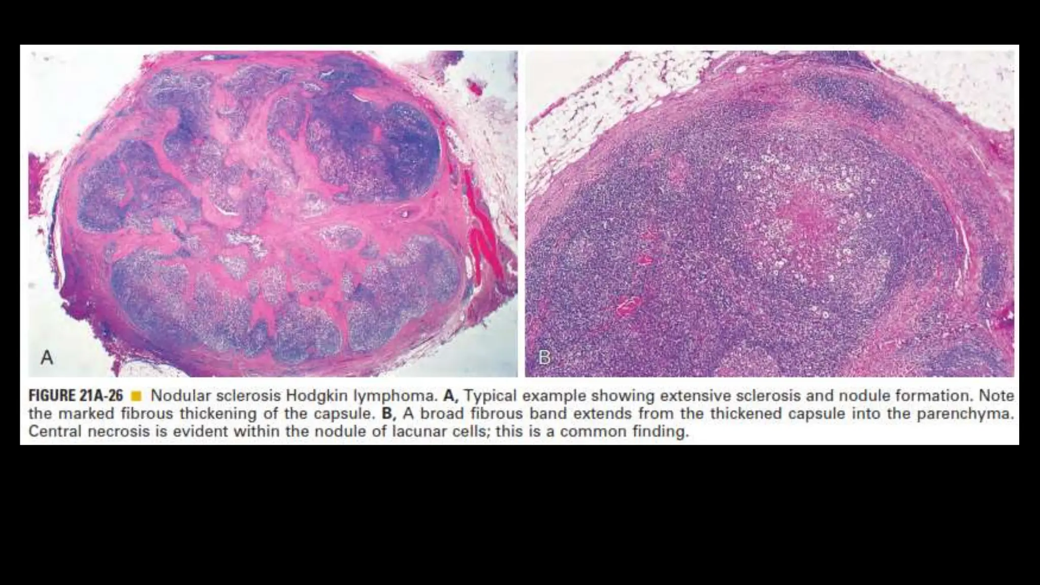 ROUND CELL TUMOR.pptx