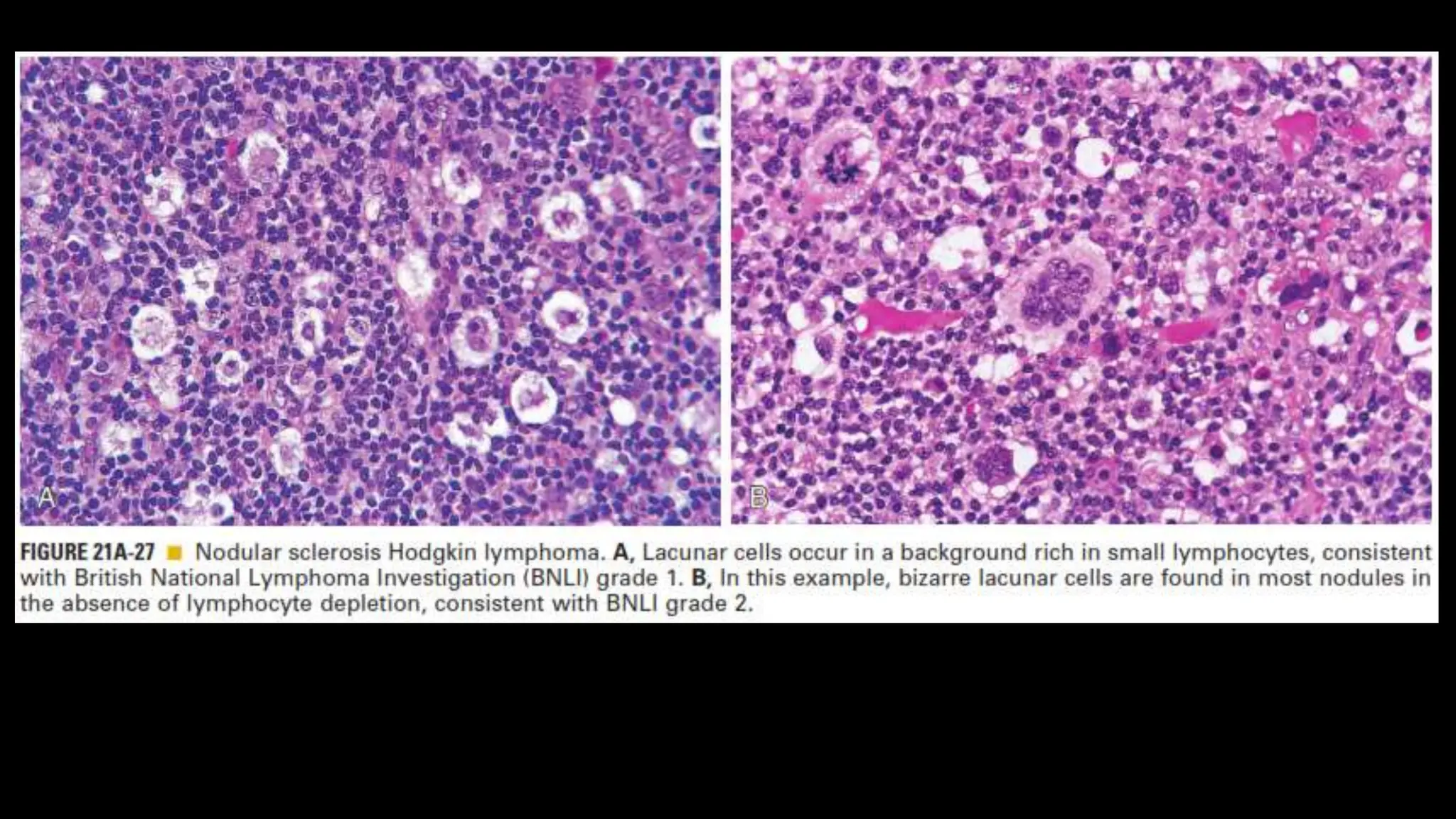 ROUND CELL TUMOR.pptx