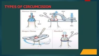 Phimosis and Paraphimosis Surgery Presentation.pptx