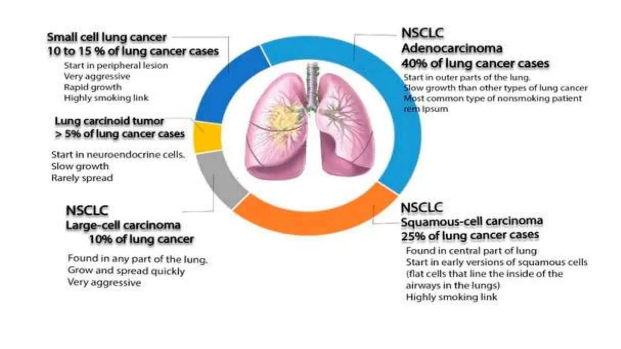 Lungs Cancer etiology sign symtom causes.pptx | Lung and Respiratory ...