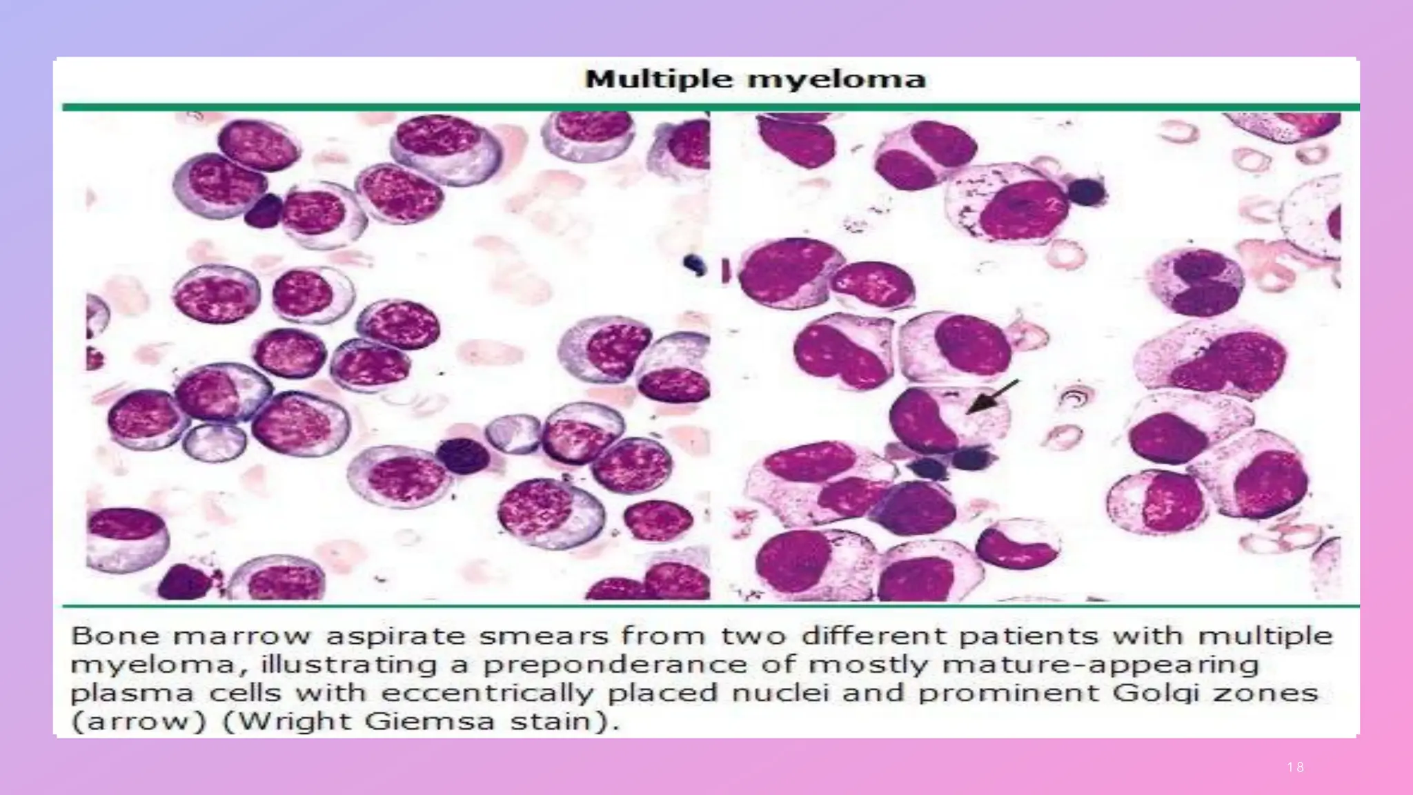 MULTIPLE MYELOMA (MM) SLIDESHARE PRESENTATION | PDF