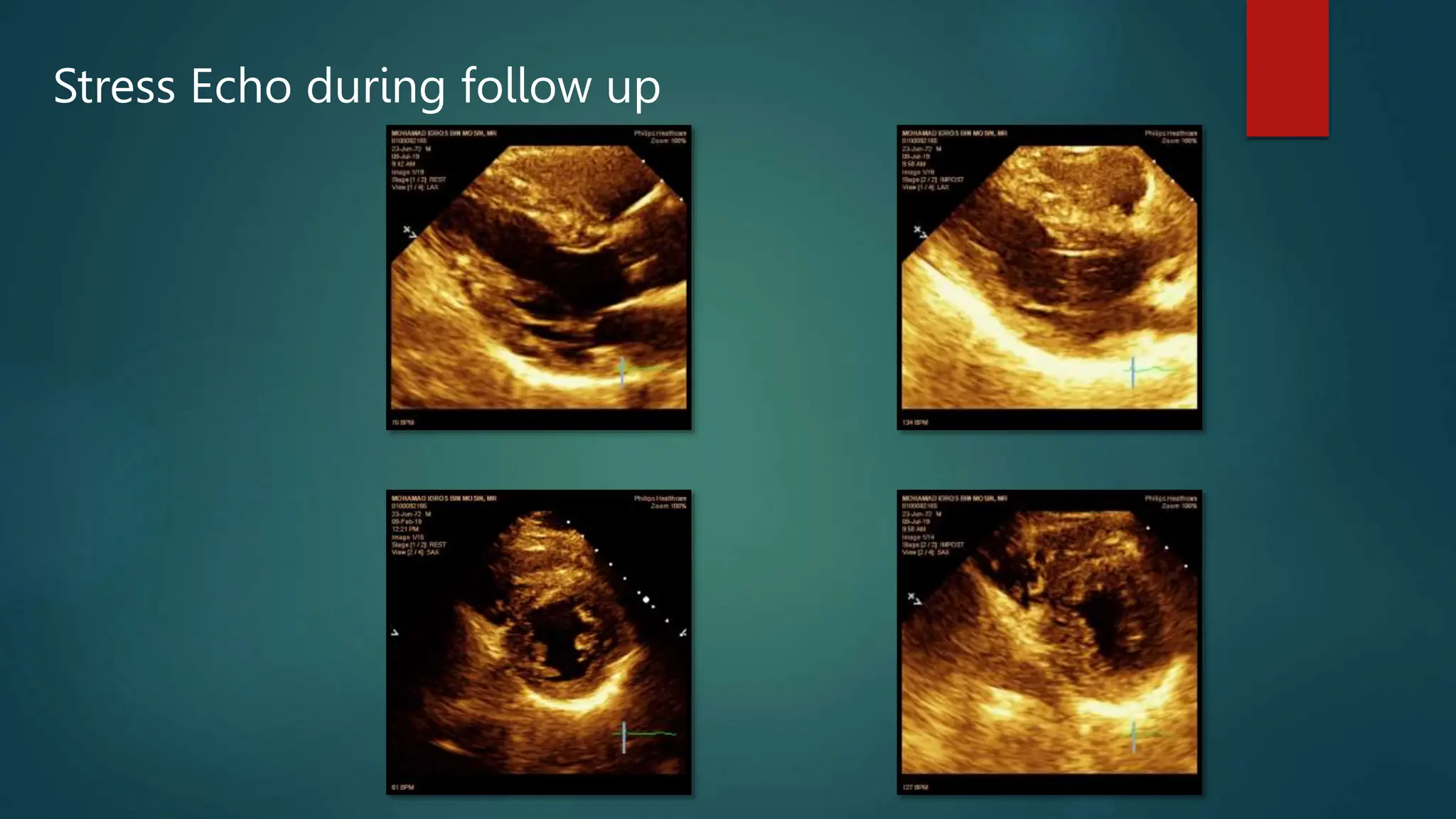 Treadmill Stress Echocardiogram normal.pptx