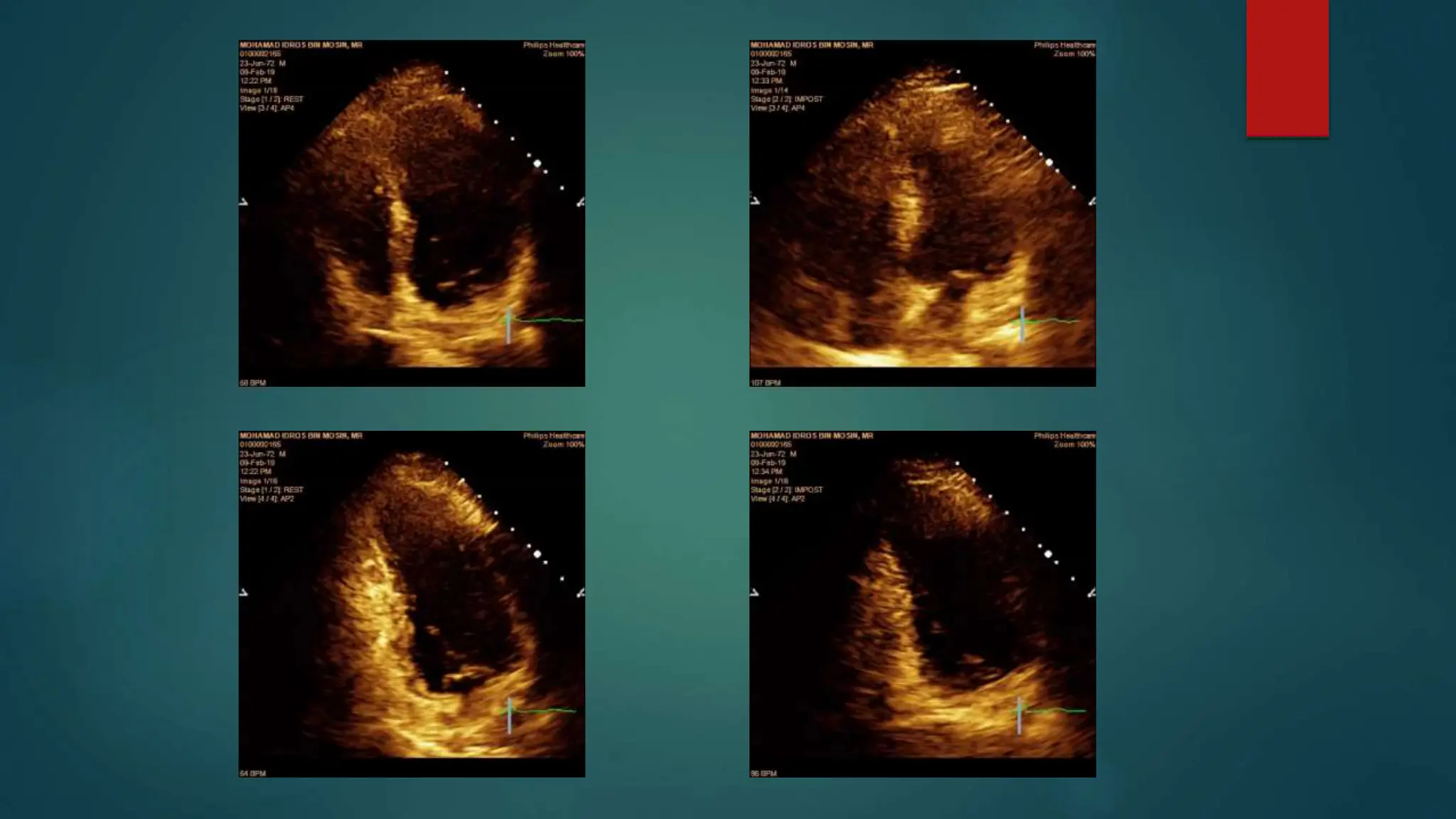 Treadmill Stress Echocardiogram normal.pptx