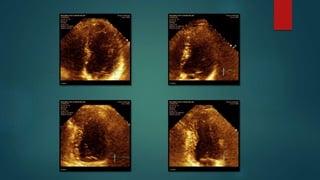 Treadmill Stress Echocardiogram normal.pptx