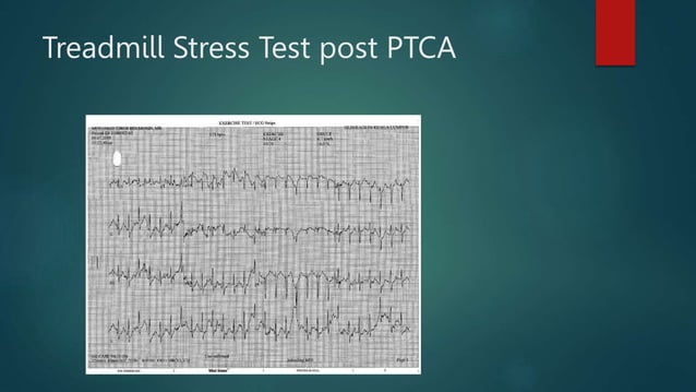 Treadmill Stress Echocardiogram normal.pptx