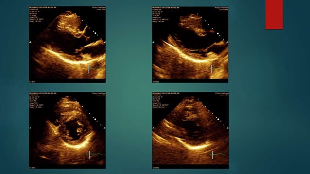 Treadmill Stress Echocardiogram normal.pptx