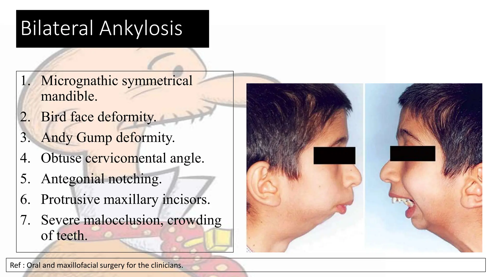 TMJ ANKYLOSIS of the Jaw and its clinical significancies | PPTX