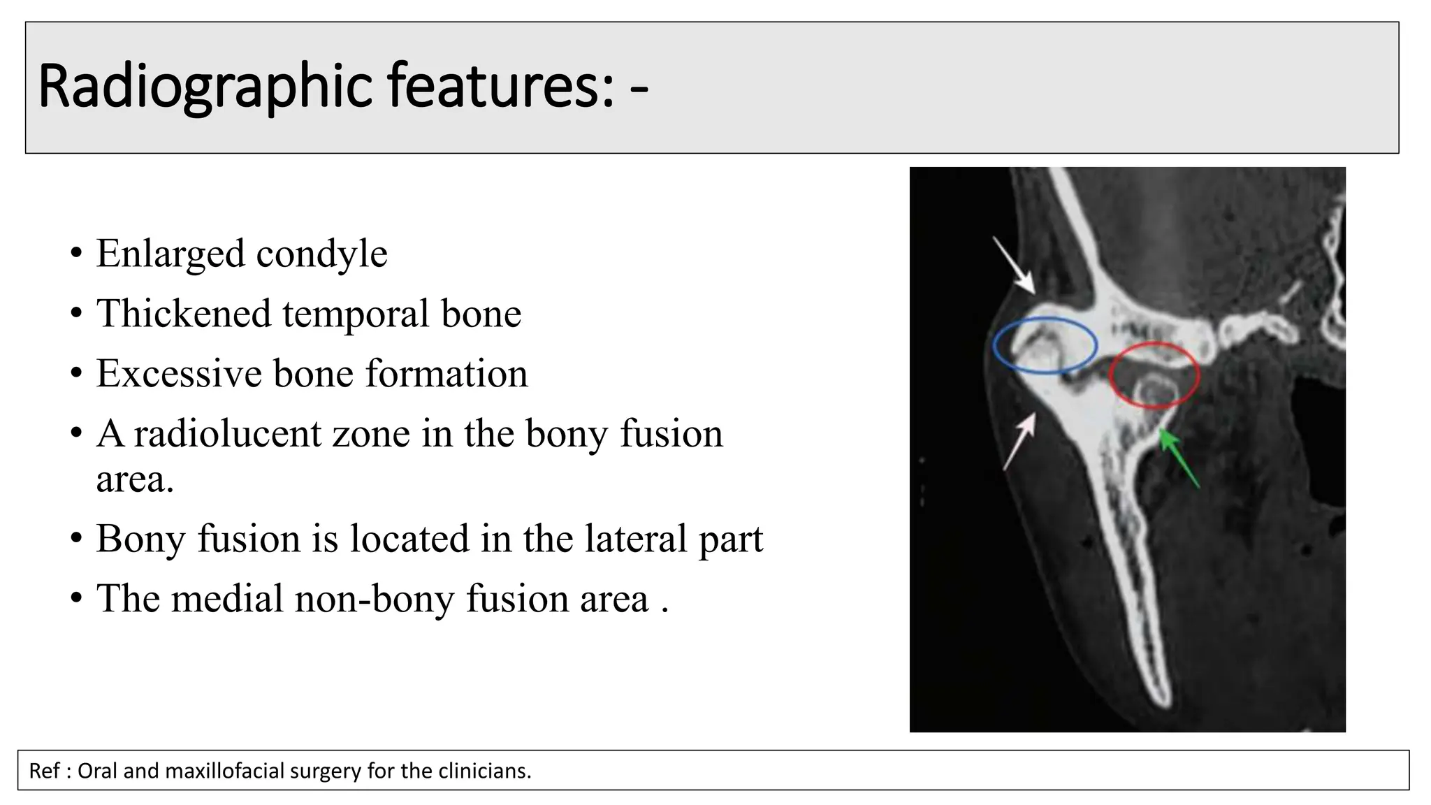 TMJ ANKYLOSIS of the Jaw and its clinical significancies | PPTX