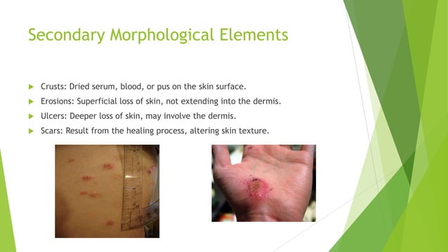 Dermatosis | PPTX | Skin and Dermatology | Diseases and Conditions