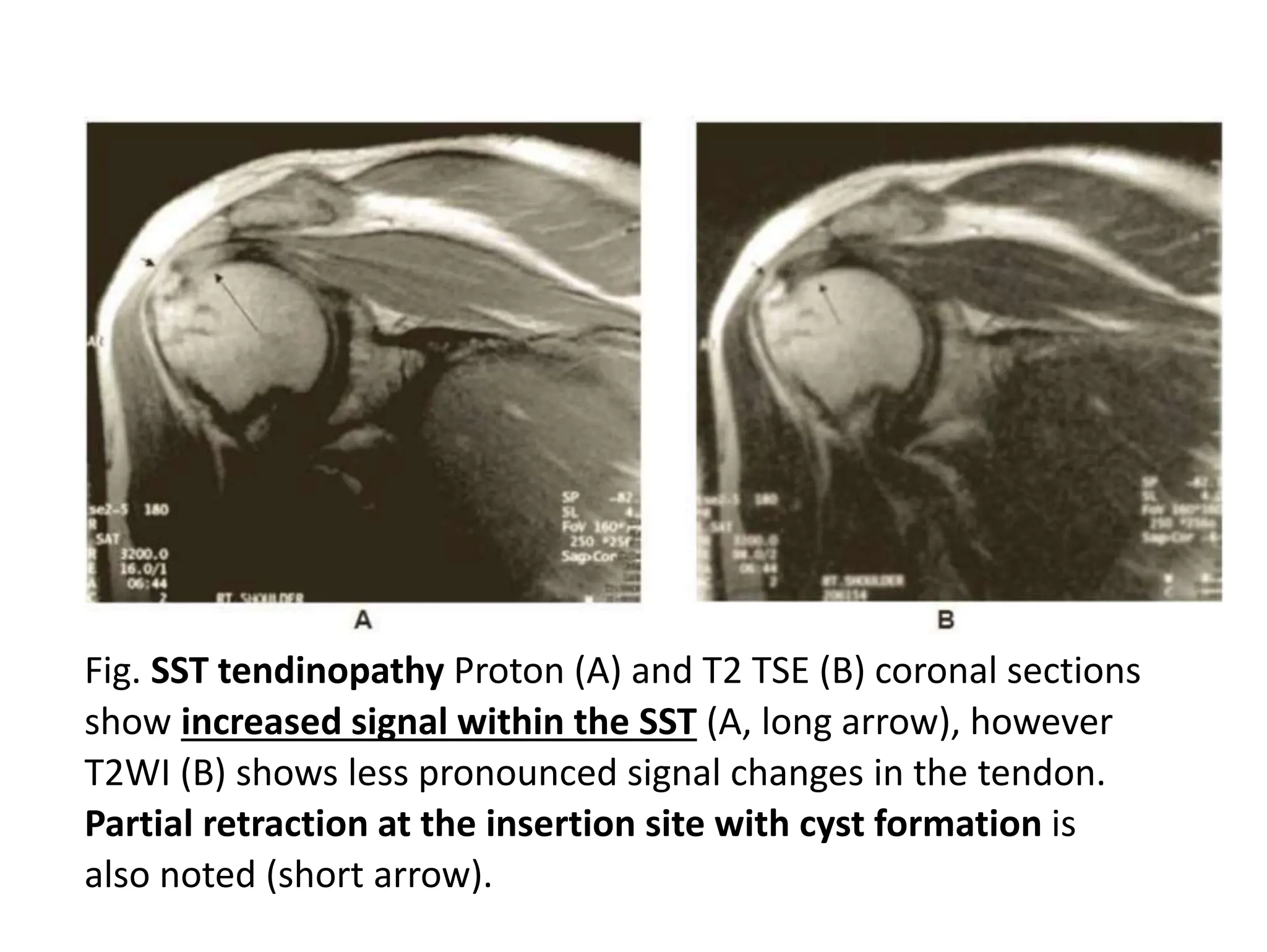 shoulder pathologies MRI: basic anatomy and MRI scans | PPTX