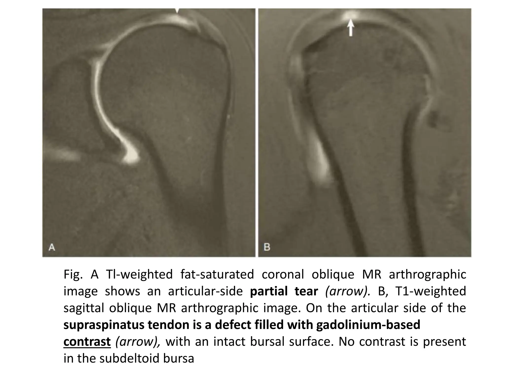 shoulder pathologies MRI: basic anatomy and MRI scans | PPTX