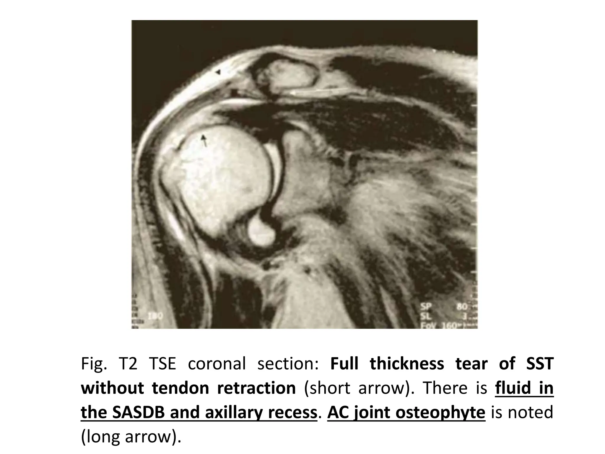 shoulder pathologies MRI: basic anatomy and MRI scans | PPTX