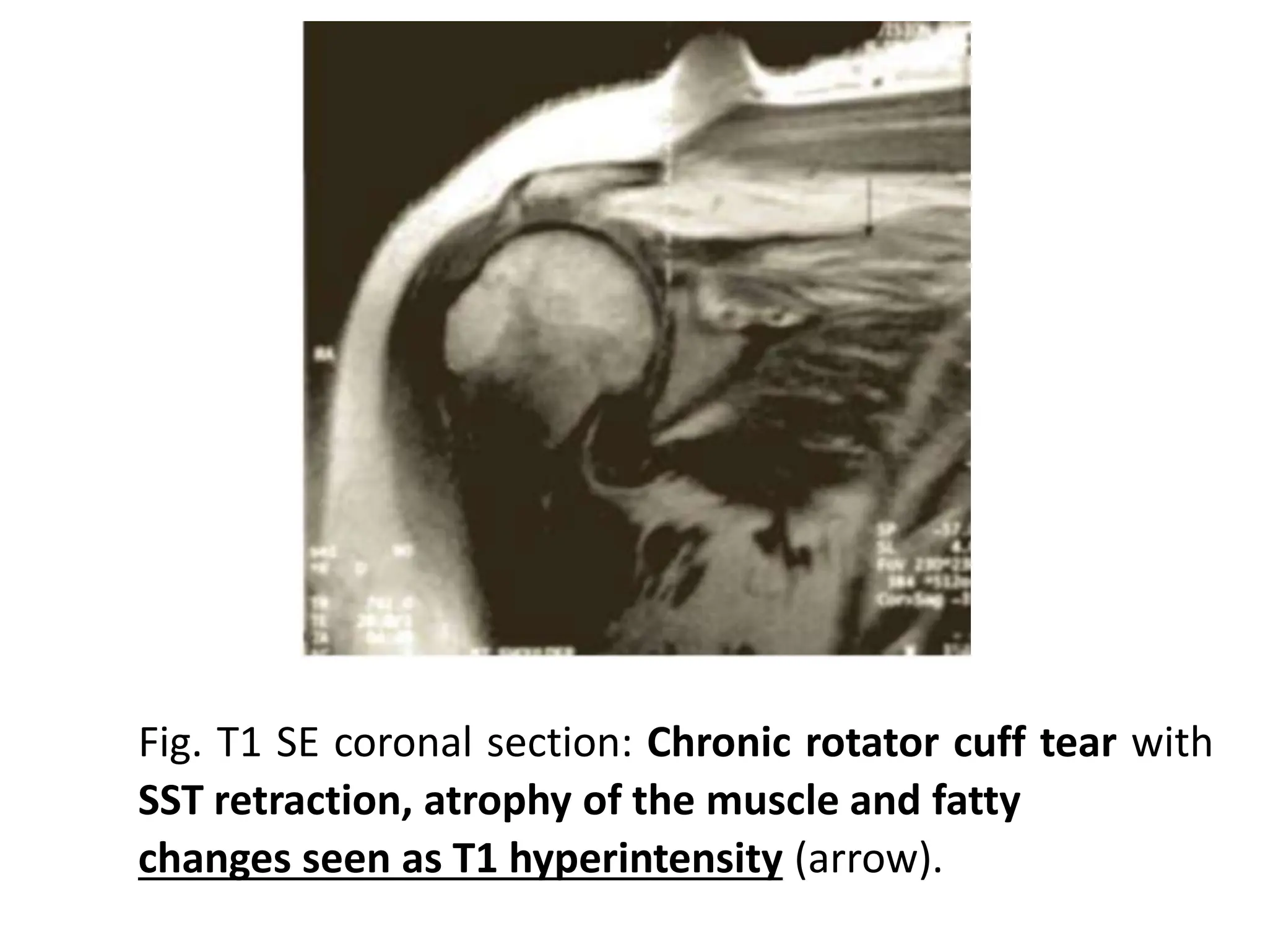 shoulder pathologies MRI: basic anatomy and MRI scans | PPTX