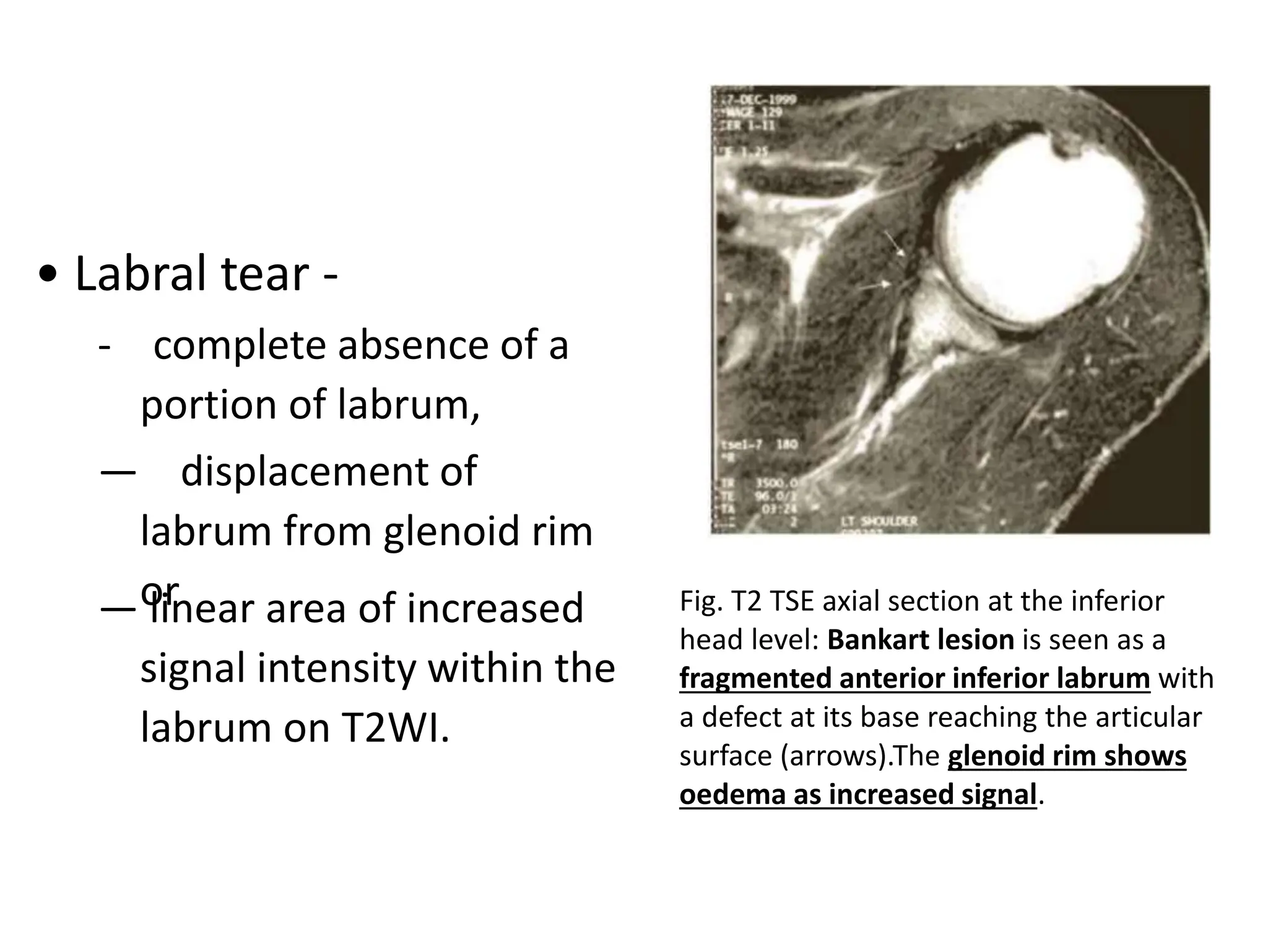 shoulder pathologies MRI: basic anatomy and MRI scans | PPTX