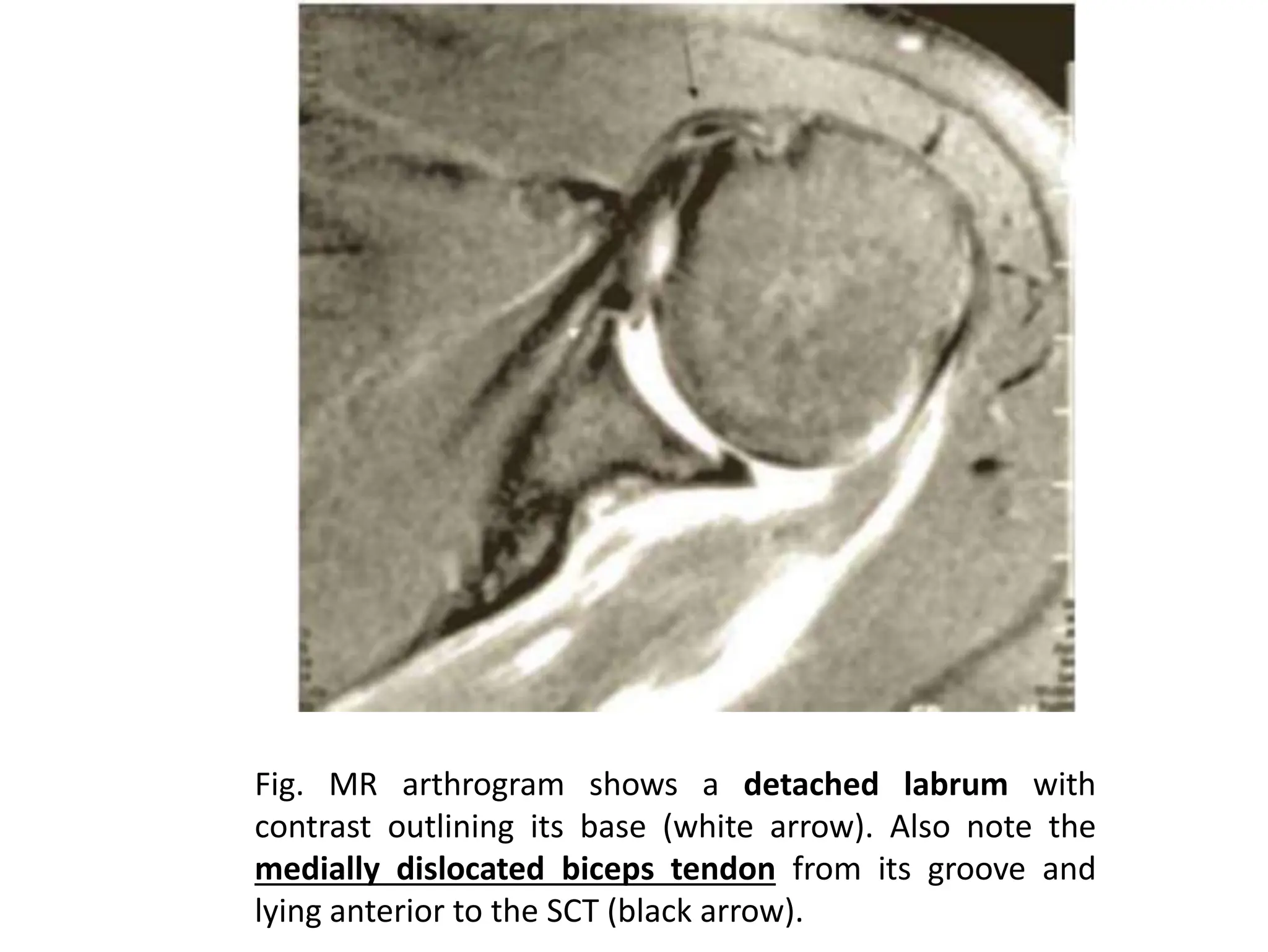 shoulder pathologies MRI: basic anatomy and MRI scans | PPTX