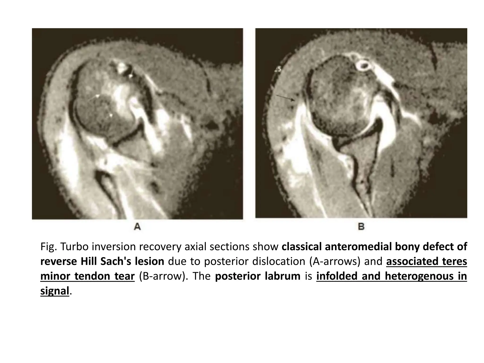 shoulder pathologies MRI: basic anatomy and MRI scans | PPTX