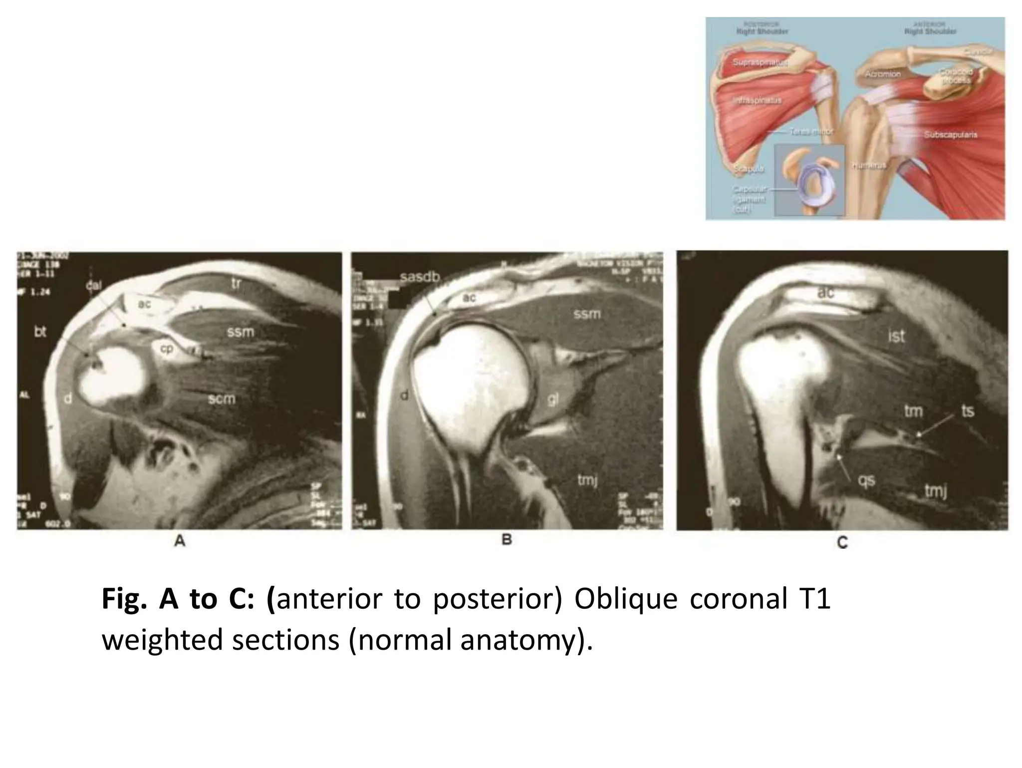 shoulder pathologies MRI: basic anatomy and MRI scans | PPTX