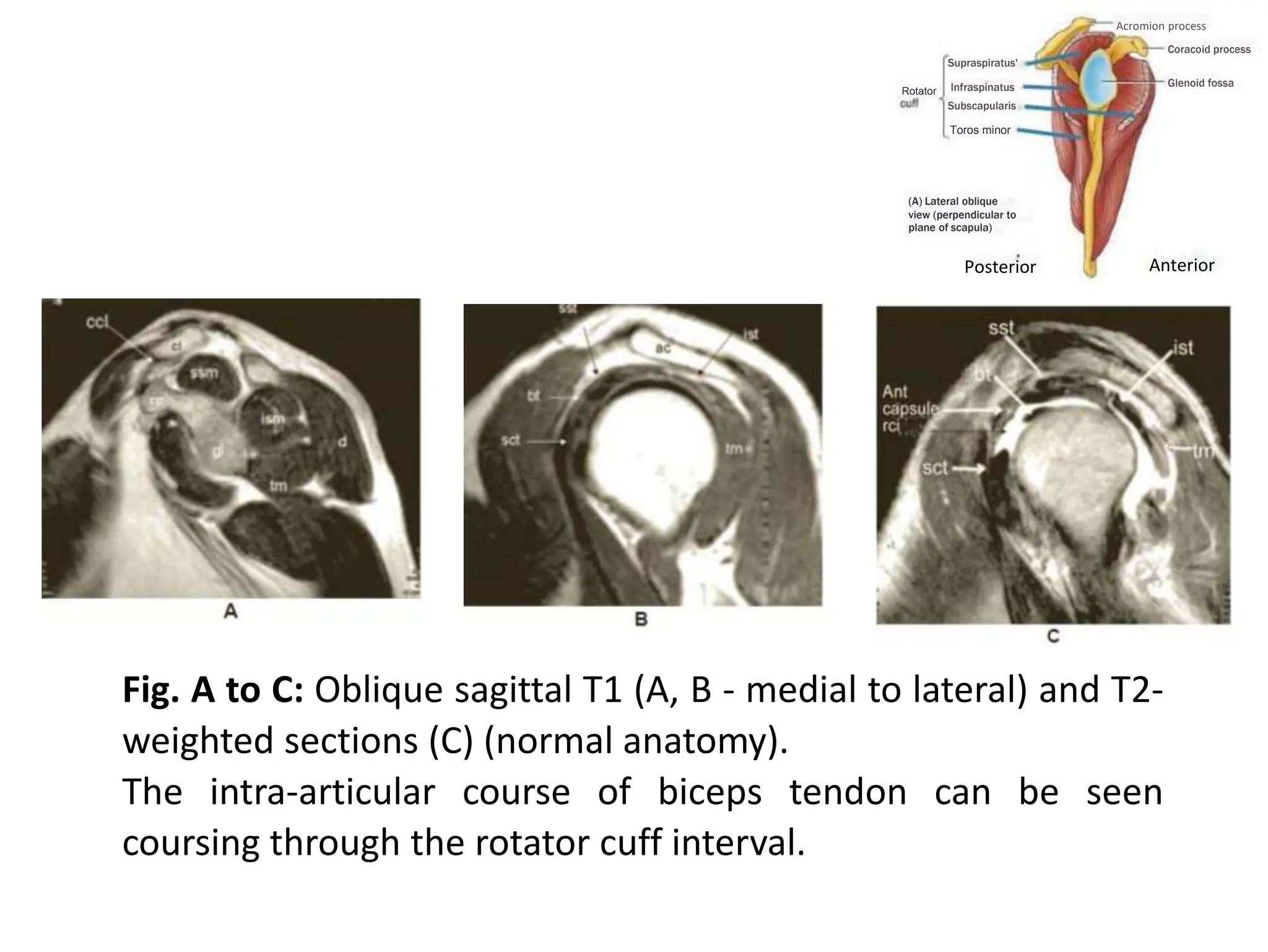 shoulder pathologies MRI: basic anatomy and MRI scans | PPTX