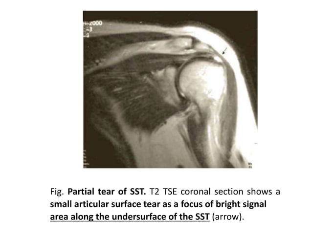 shoulder pathologies MRI: basic anatomy and MRI scans | PPTX