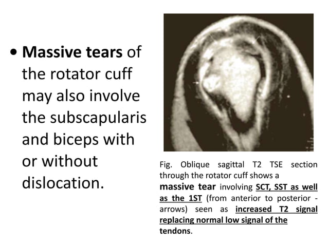 shoulder pathologies MRI: basic anatomy and MRI scans | PPTX