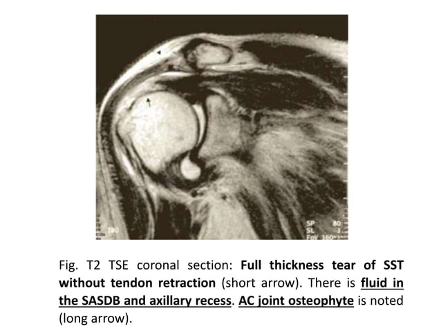 shoulder pathologies MRI: basic anatomy and MRI scans | PPTX