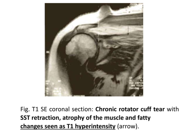 shoulder pathologies MRI: basic anatomy and MRI scans | PPTX