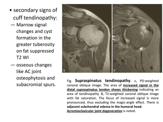 shoulder pathologies MRI: basic anatomy and MRI scans | PPTX