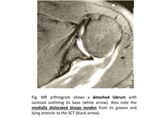 shoulder pathologies MRI: basic anatomy and MRI scans | PPTX