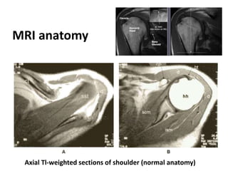 shoulder pathologies MRI: basic anatomy and MRI scans | PPTX