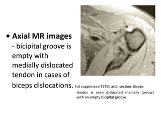 shoulder pathologies MRI: basic anatomy and MRI scans | PPTX