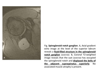 shoulder pathologies MRI: basic anatomy and MRI scans | PPTX