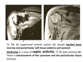shoulder pathologies MRI: basic anatomy and MRI scans | PPTX