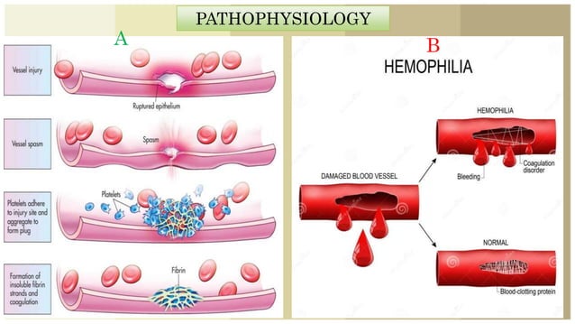 World Haemophilia Day : Bleeding disorders | PPT