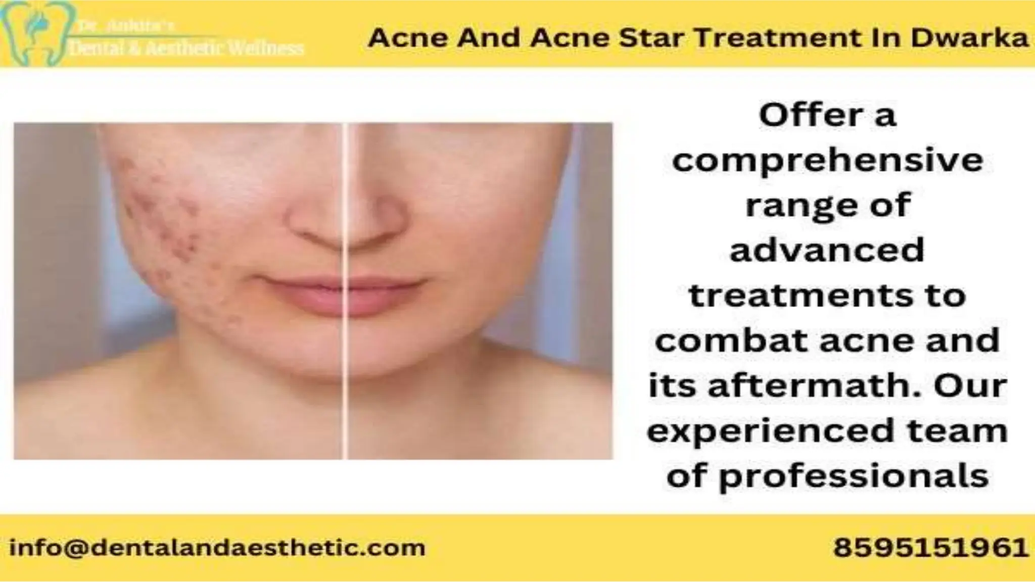 Acne And Acne Star Treatment In Dwarka ncr | PPT
