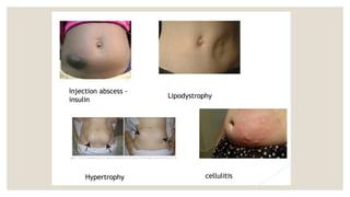 Presentation (1).pdf subcutaneous injection | PDF