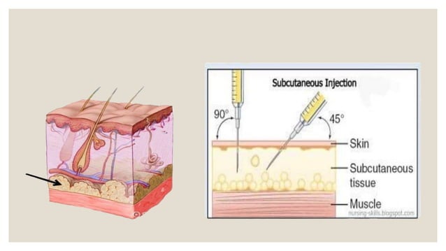 Presentation (1).pdf subcutaneous injection | PPT