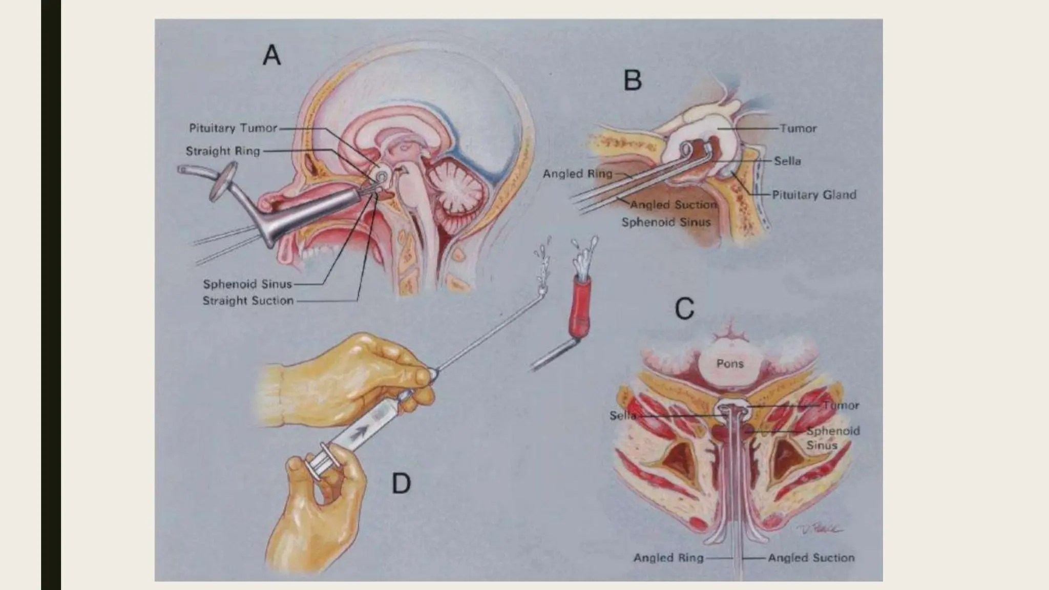 Operative Techniques and Instrumentation in Neurosurgery | PPTX