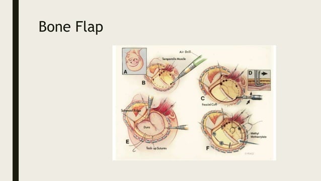 Operative Techniques and Instrumentation in Neurosurgery | PPTX