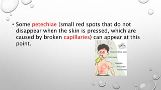 Dengue fever presentation by varsha BAMS | PPTX