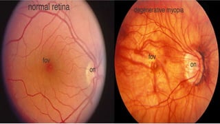 Myopia , etilogy , classification and treatment.pptx