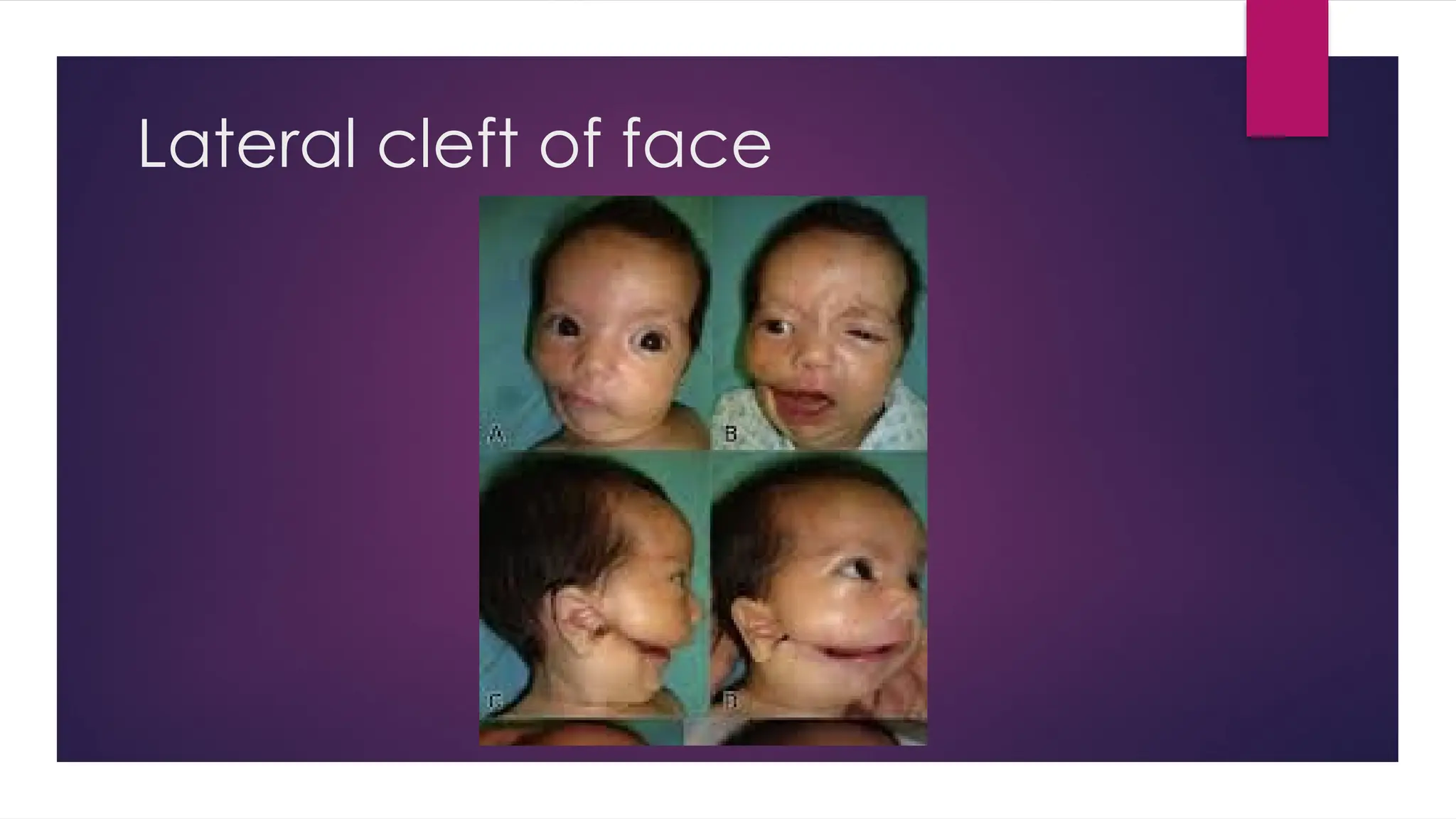 CLEFT LIP AND PALATE PLASTIC SURGERY PRESENTATION | PPTX