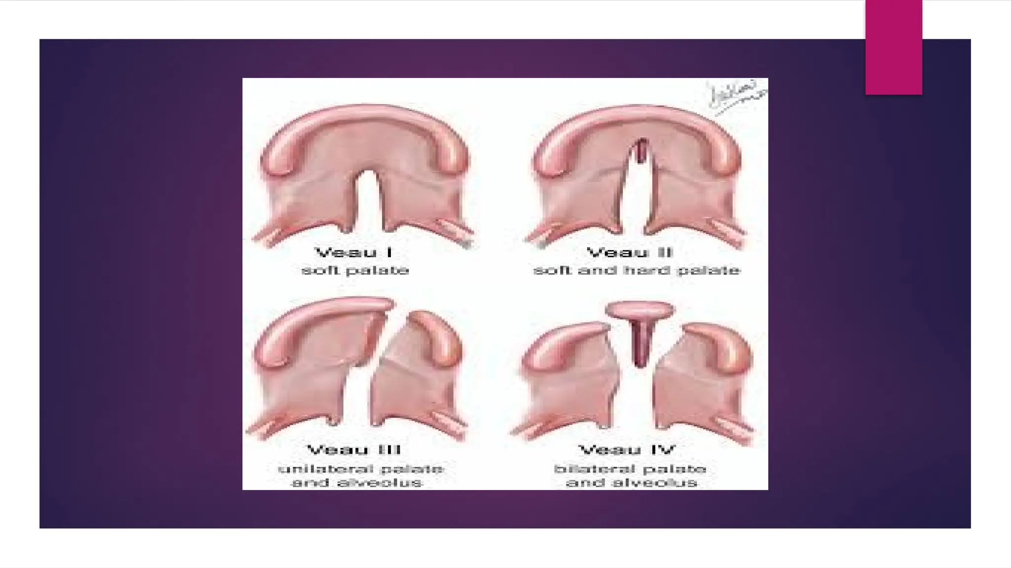 CLEFT LIP AND PALATE PLASTIC SURGERY PRESENTATION | PPTX