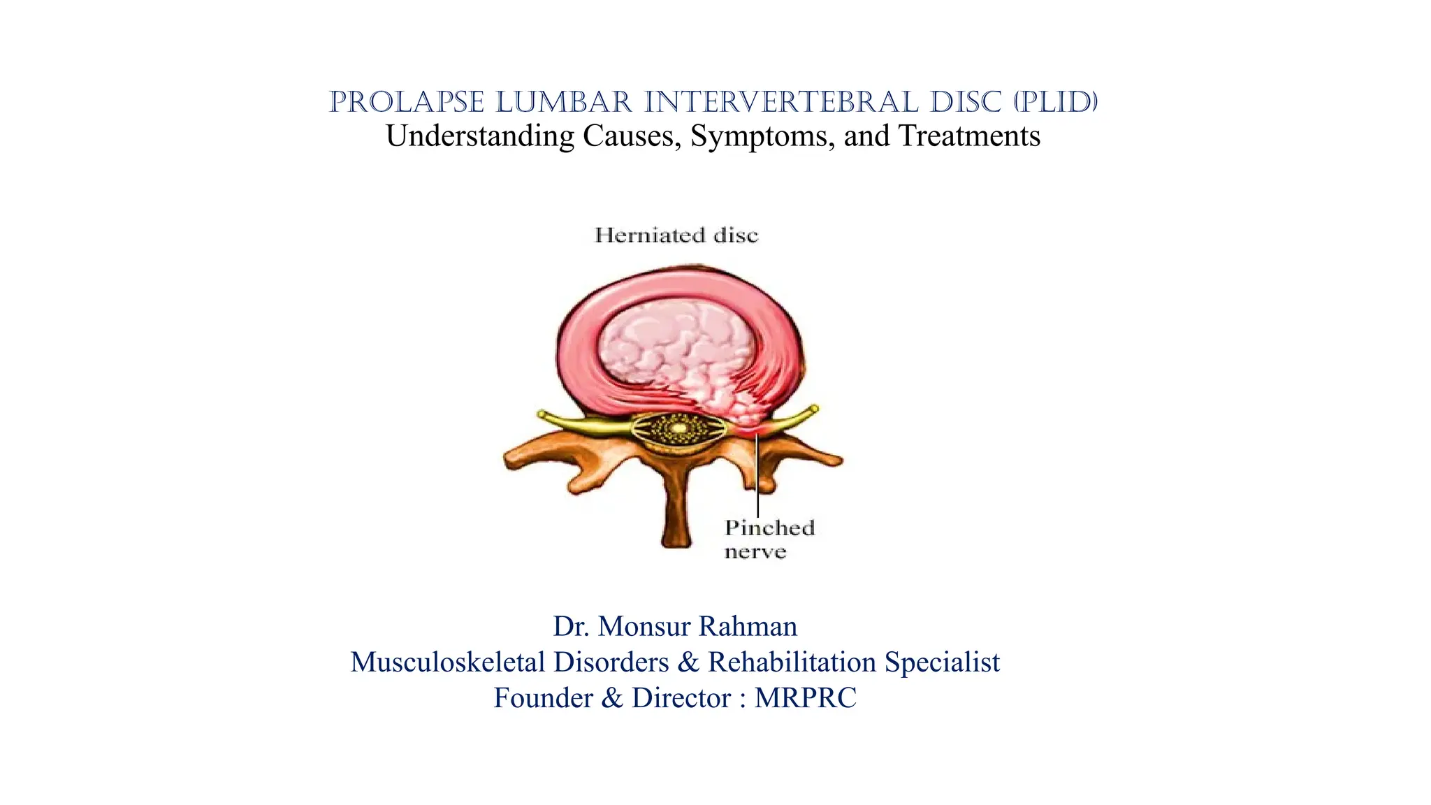 PLID: Understanding Causes, Symptoms, and Treatments | PPTX