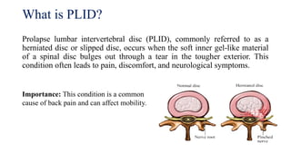 PLID: Understanding Causes, Symptoms, and Treatments | PPTX