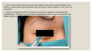 Local anesthetic- extraoral facial blocks | PPTX