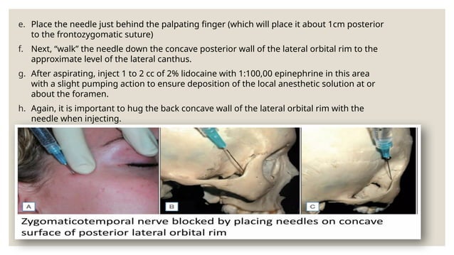 Local anesthetic- extraoral facial blocks | PPTX