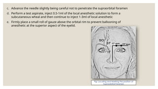 Local anesthetic- extraoral facial blocks | PPTX