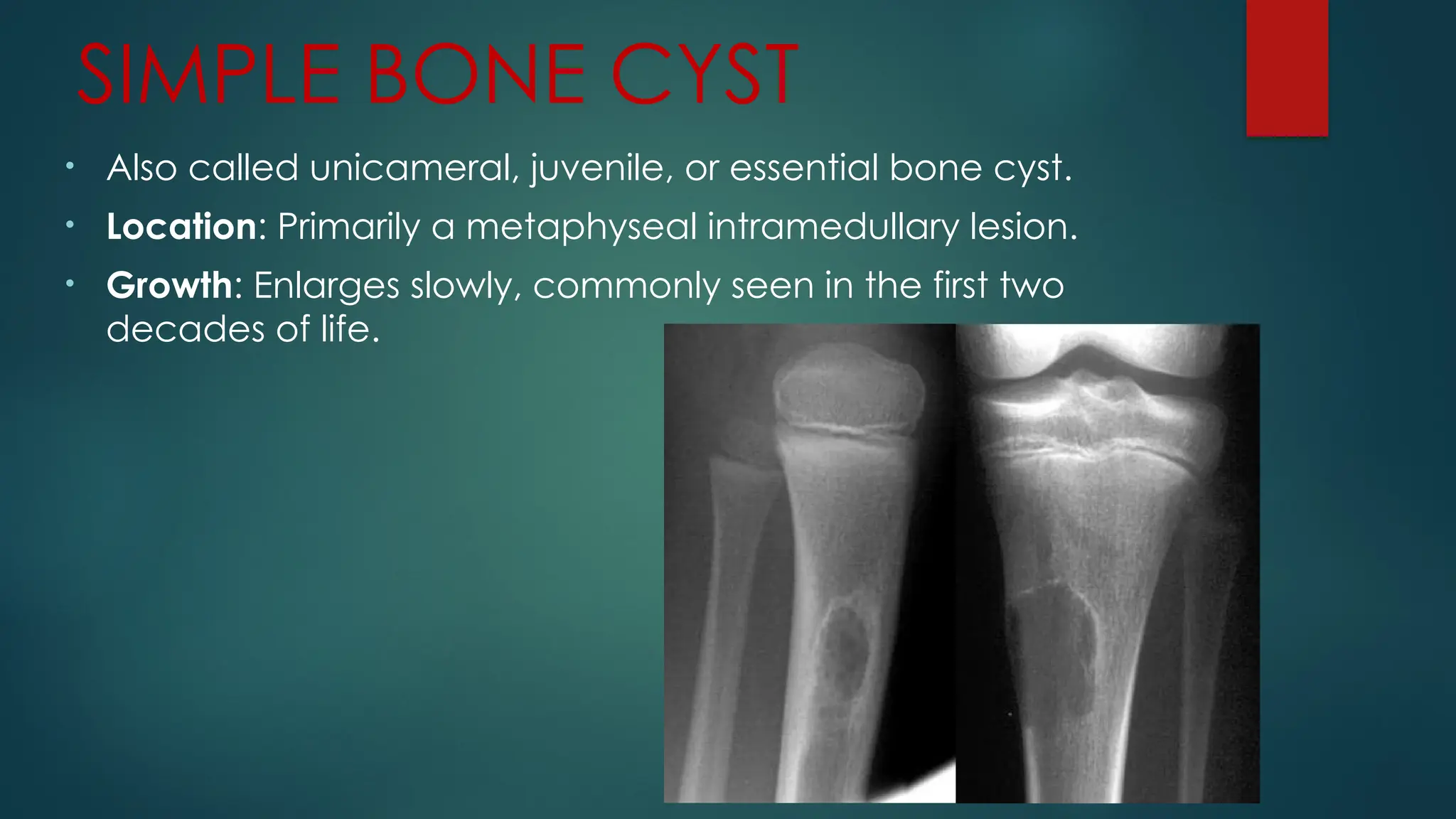 Bone tumors-fibrous dysplasia,simple bone cyst,aneurysmal bone cyst | PPT