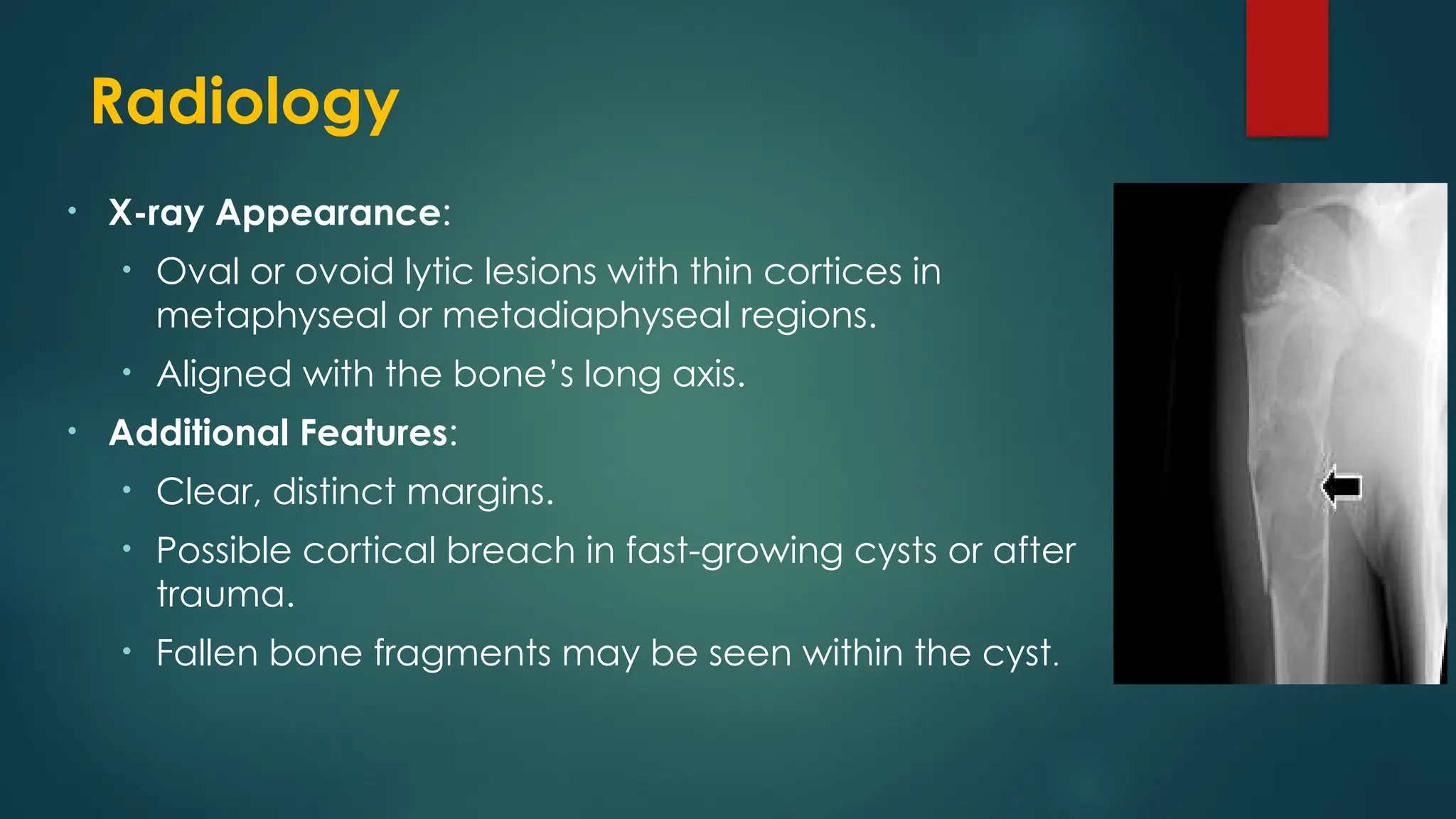 Bone tumors-fibrous dysplasia,simple bone cyst,aneurysmal bone cyst | PPT